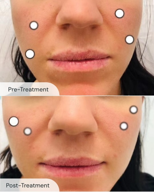 PRP Treatment – Beauty Pharm Supply Clinic